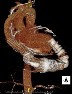 Technological Advances Lead to Improved Survival with Permanent Left ...