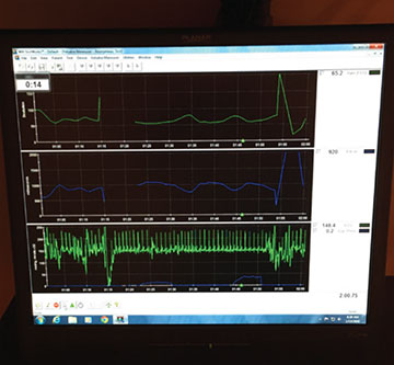 Early Testing Aids in Correctly Diagnosing, Potentially Treating ...