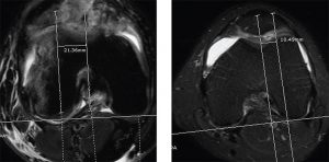 Measurement of Tibial Tubercle to Trochlear Groove (TT-TG) Distance by ...