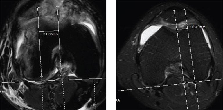 Measurement of Tibial Tubercle to Trochlear Groove (TT-TG) Distance by ...