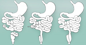 When Skipping a Step is a Good Thing: Stoma-Free Ileal Pouches for ...