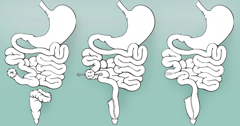 When Skipping a Step is a Good Thing: Stoma-Free Ileal Pouches for ...